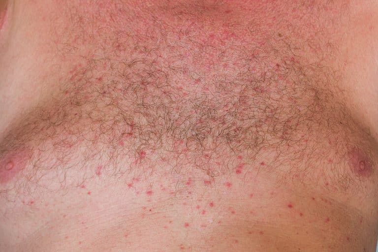 Jeukende bultjes zonder insect te zien: vogelmijt, bedwants of allergie ...