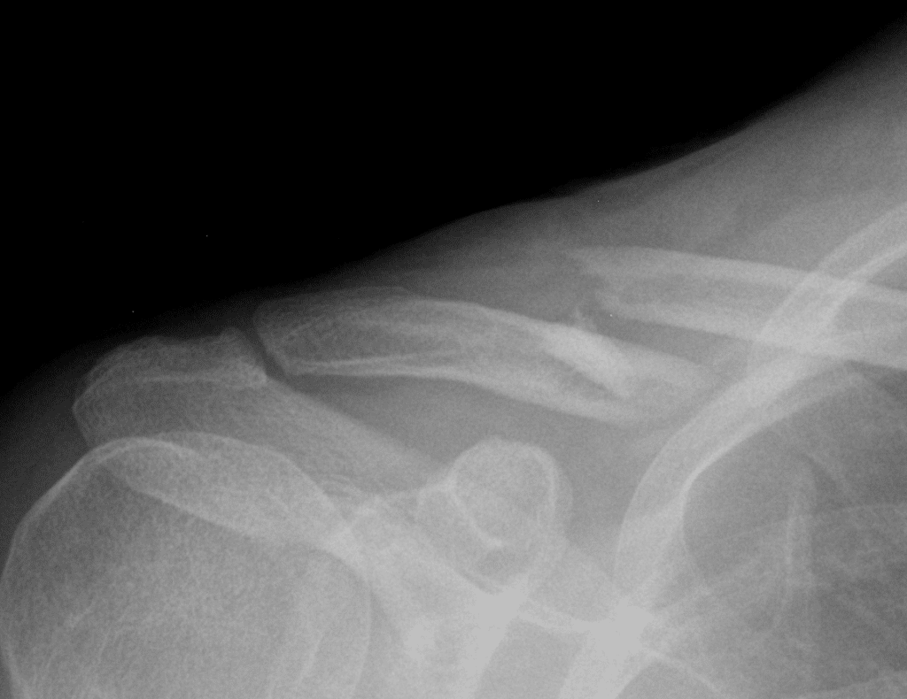 Bult op sleutelbeen: oorzaken van een knobbel - Mens & Gezondheid