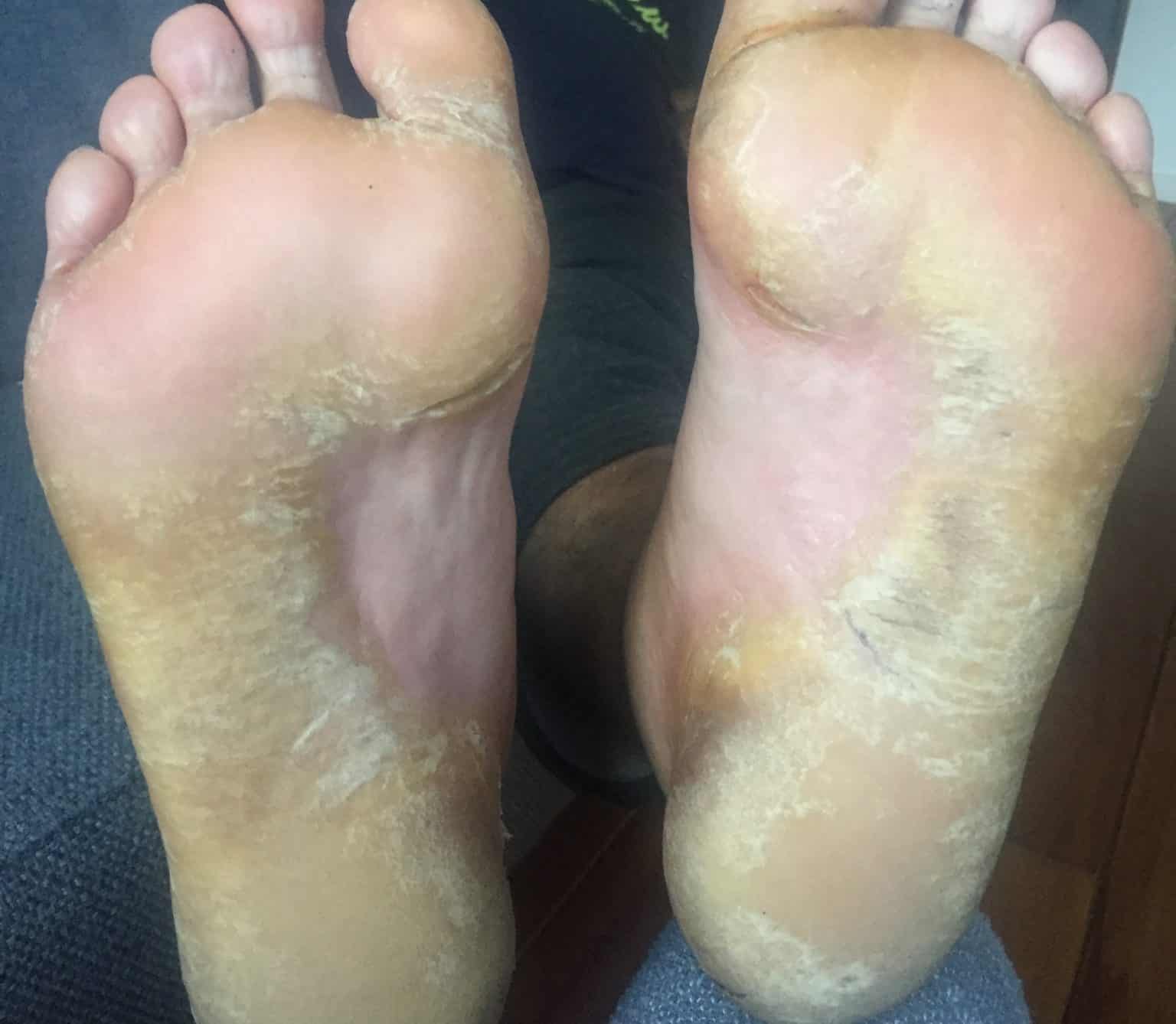 Eczeem: symptomen, oorzaak en behandeling - Mens & Gezondheid