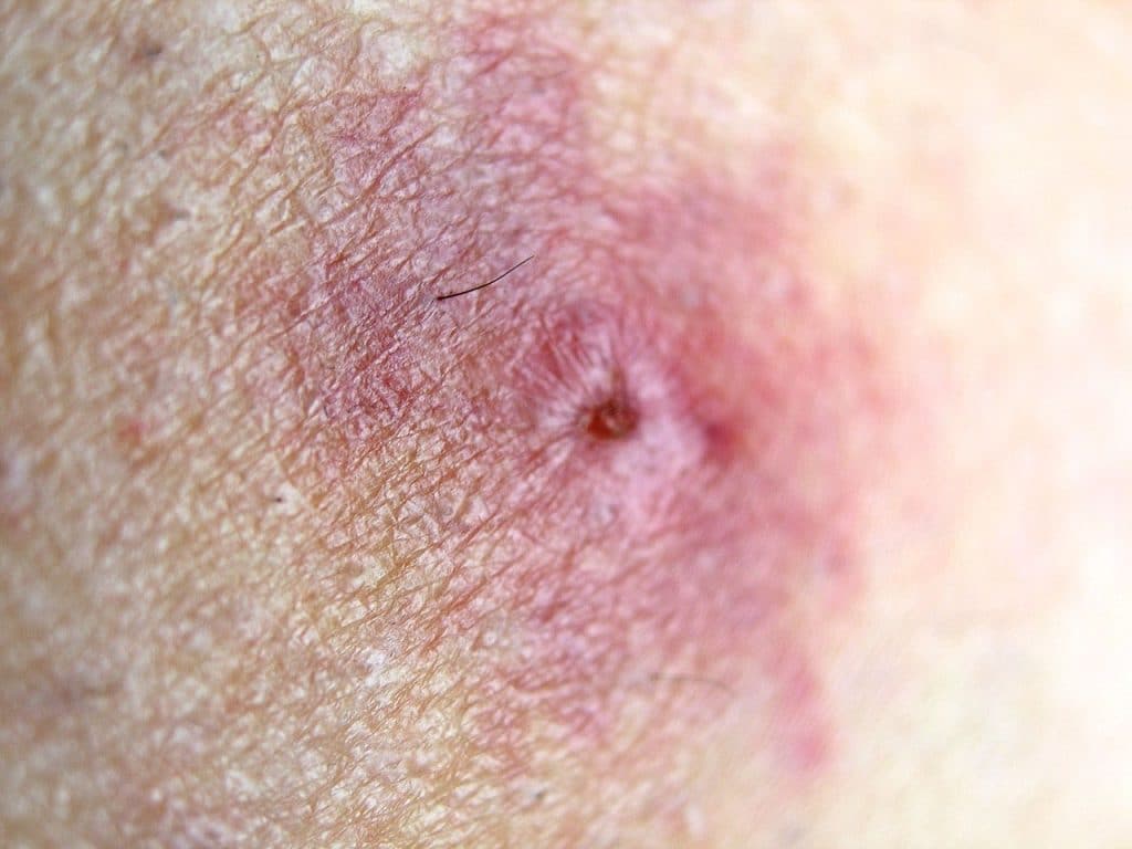 Knutten: herkennen en behandelen beet kleine steekvliegjes - Mens ...