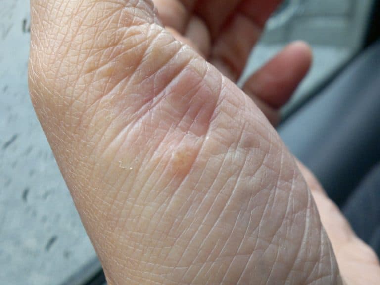 Psoriasis pustulosa: symptomen, oorzaak en behandeling - Mens & Gezondheid
