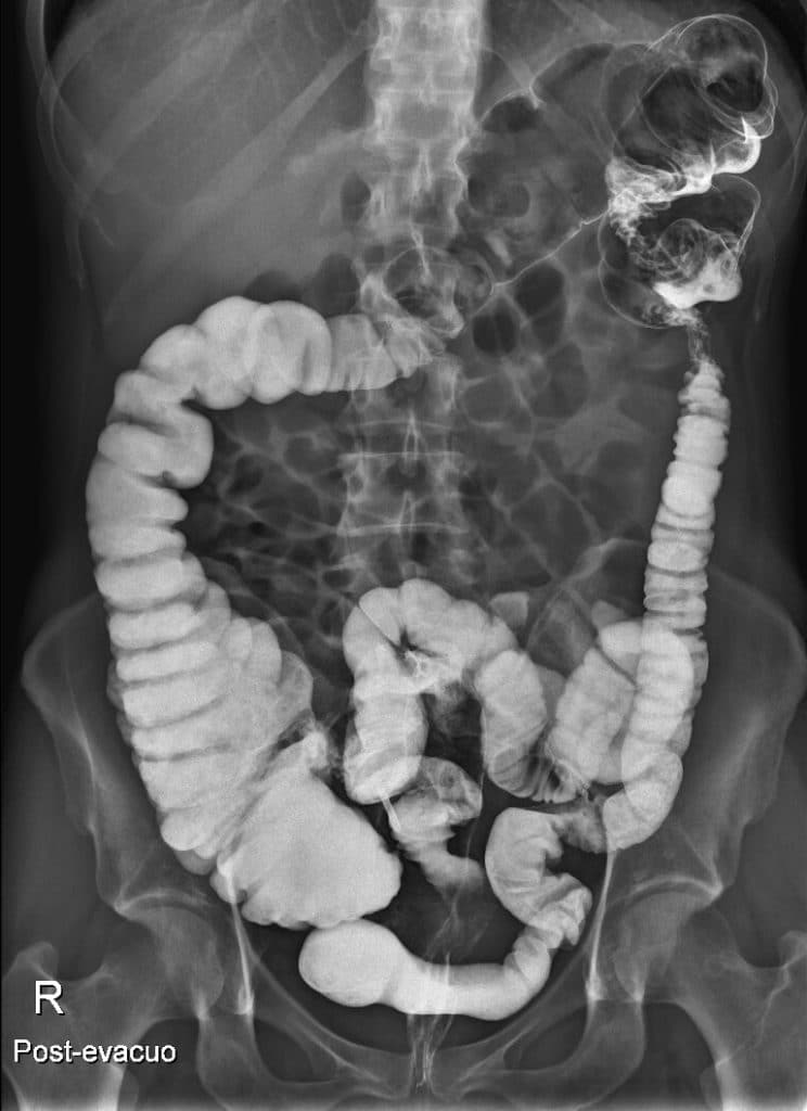 Dolichocolon: een bochtige en te lange dikke darm - Mens & Gezondheid