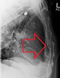 Gebroken borstbeen: symptomen, oorzaak en behandeling - Mens & Gezondheid